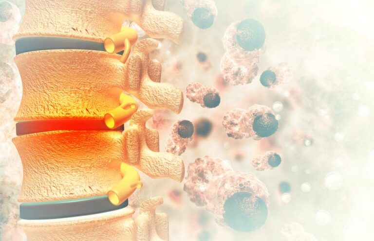 Rakovina kostí postihuje především mladé jedince. Poznejte její projevy ...